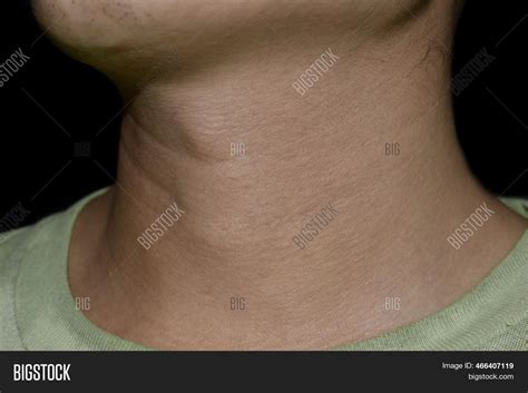 Hyperthyroidism Neck