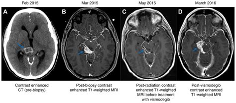 Basal Cell Nevus Syndrome Radiology