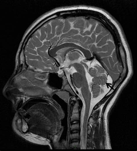Brain Magnetic Resonance Imaging Midline Sagittal T2 Weighted Image Download Scientific