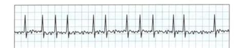 Atrial Fibrillation Person Ecg Signal Download Scientific Diagram