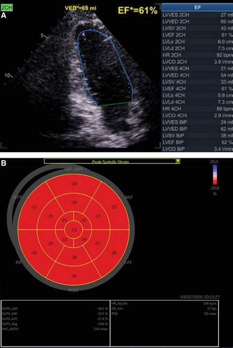 Two Dimensional Speckle Tracking Echocardiography A Powerfu Medicine