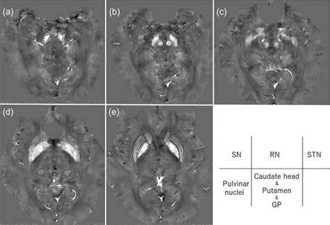 Quantitative Susceptibility Mapping Qsm Images Examples Of The
