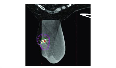 Representative Patient Treated In The Prone Position With Biozorb ™ Download Scientific