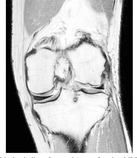Pdf Complications After Meniscus Allograft Transplantation Semantic