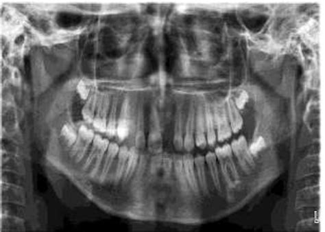 Intraoral Upper Occlusal View Of Case 1 Download Scientific Diagram