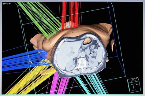 Revolutionizing Cancer Care The Impact Of Chatgpt In Radiotherapy