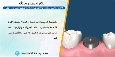 هیلینگ ایمپلنت چیست؟ دکتر احسان بیرنگ