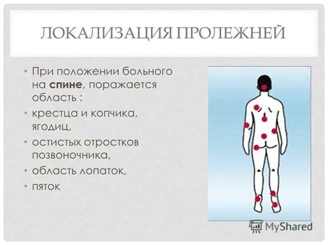 Презентация на тему: " ПРОЛЕЖНИ. ПРОФИЛАКТИКА ПРОЛЕЖНЕЙ ". Скачать ...