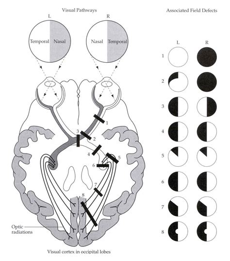 Visual Field Defects Chart Ponasa