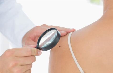 Significance Of Moles At Different Body Parts Dgtl Anandabazar