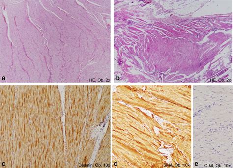 The Gastrinoma Accompanied Muscular Disorders Consists Of Hypertrophy Download Scientific