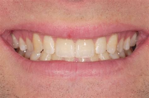 Conventional Braces Smilecraftgoa