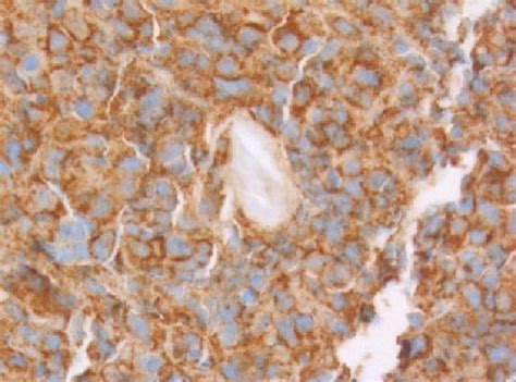 Primary CNS Lymphoma Arising From The 4th Ventricle A Diffuse Sheets Download Scientific