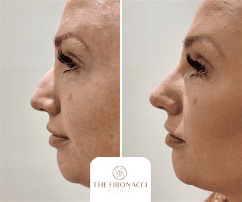 Nose Filler Non Surgical Nose Jobrhinoplasty The Fibonacci Clinic