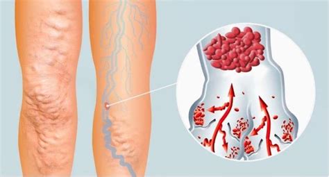 Flebitis En El Brazo Aderontsteking Flebitis Symptomen En