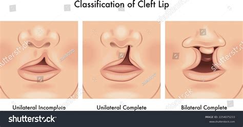 Medical Illustration Shows Classification Cleft Lip Stock Vector
