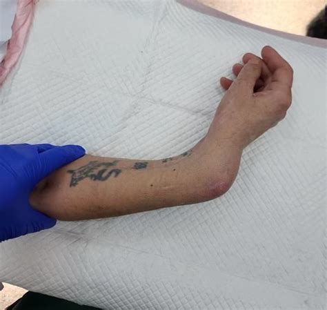 Melbourne Arm Clinic Before ⬅️ 3 Previously Failed Internal Fixation Attempts For A Humeral