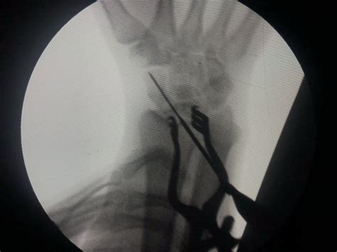 Scaphoid Proximal Pole Fracture R Radiology