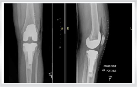 Figure 3 From Tibial Component Revision Arthroplasty Using Porous Tantalum Cone For Symptomatic