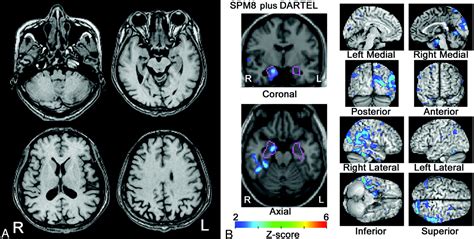 Automatic Voxel Based Morphometry Of Structural Mri By Spm8 Plus