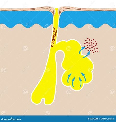 Acne Vulgaris Or Pimple Formation Process Vector Illustration CartoonDealer Com 90879358