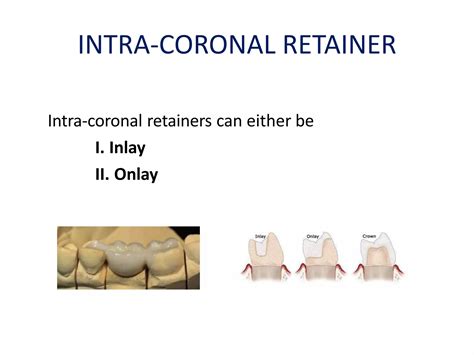 Retainers In Fpd Ppt
