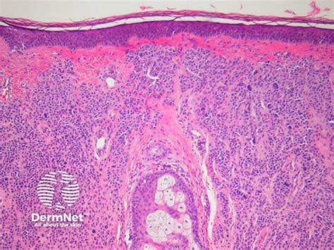 Benign Nevus Histology Intramucosal Melanocytic Nevi Ccide