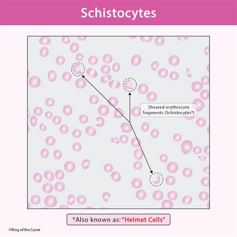 🩸 Schistocytes What Are Helmet Cells And Why Do They Matter — King Of