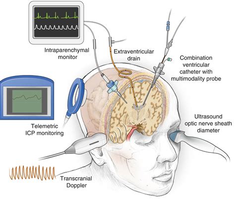 Intracranial Pressure Monitoring Clinical Tree