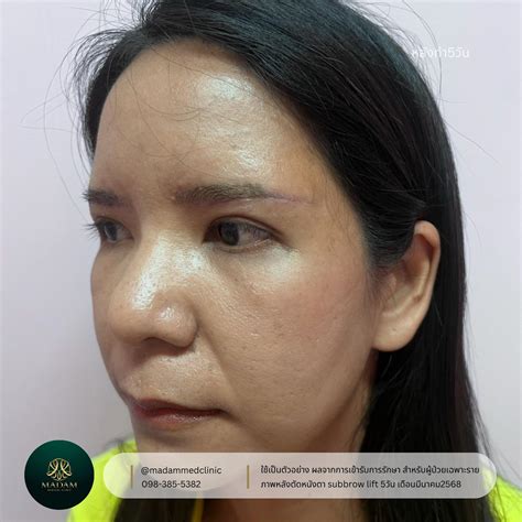 Madam 📌ยกหางคิ้ว ตัดหนังตา ซ่อนแผลใต้คิ้ว Subbrow Lift แผลสวย หลังทำ5วัน คืนชั้นตาสวย สดใส