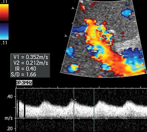 Hepatic Artery Ultrasound