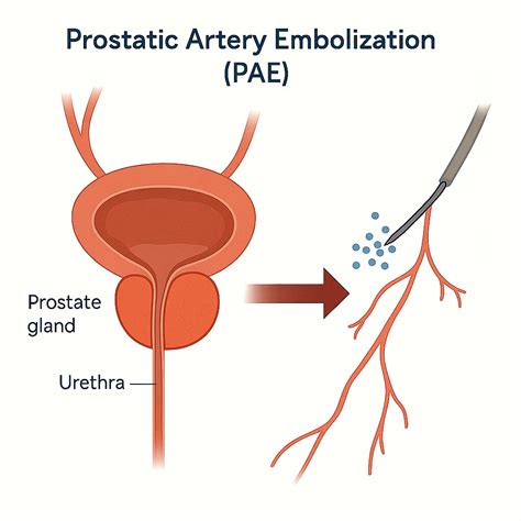 สรุปสาระสำคัญจากงานวิจัยเรื่อง Prostatic Artery Embolization Pae Mid