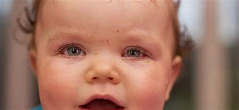 Conjunctivitis In Babies What To Do Healthy Food Near Me