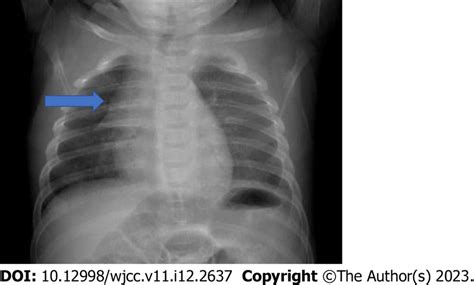The Wave Sign Blue Arrow Is The Corrugation View Of The Right Lobe Of