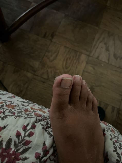 Corn On Big Toe R Footfunction