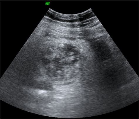 Ultrasound Picture Using A Low Frequency Probe Showing A Low Download Scientific Diagram