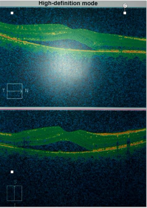 Oct Showing Retinal Serous Detachment Download Scientific Diagram