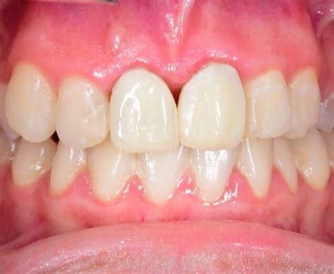 Diş Eti Çekilmesi Tedavi Ücreti