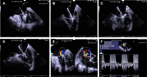 Tricuspid Valve Repair By Leaflet Approximation Procedure Monitored By