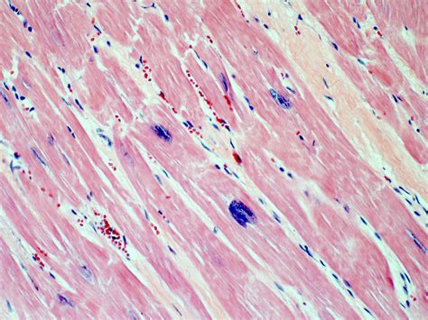 Myocardial Infarction Pathology