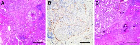 Histopathological Features Of Diffuse Sclerosing Variant Of Papillary Download Scientific