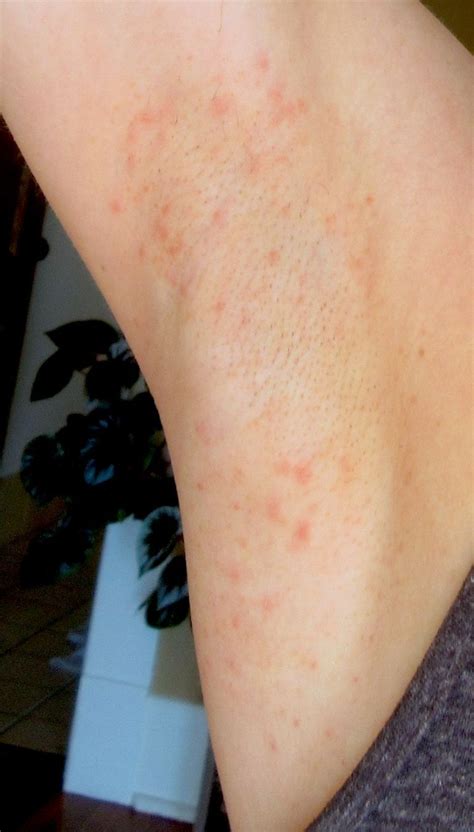 Eight Skin Rashes You Need To Know Artofit