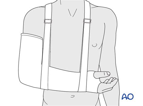 Orif Plating For Simple Fracture Of The Ulna With Dislocation Of