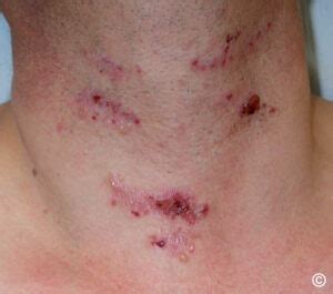 Celiac Disease Diagnosis Symptoms Treatment Diet And Foods To Avoid
