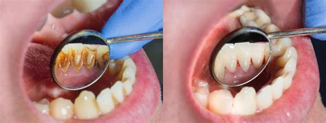 Черный налет на зубах — причины и способы его убрать | Dental Med