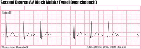 Ecg Educator Blog Second Degree Av Block Mobitz Type I Wenckebach