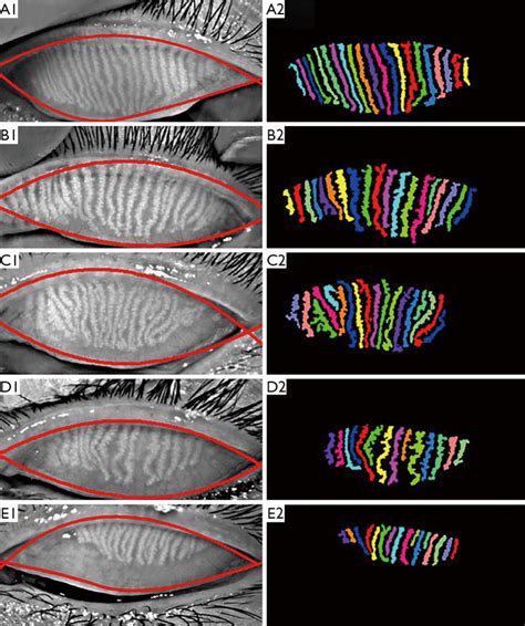 an automated and multiparametric algorithm for objective analysis of meibography images pmc
