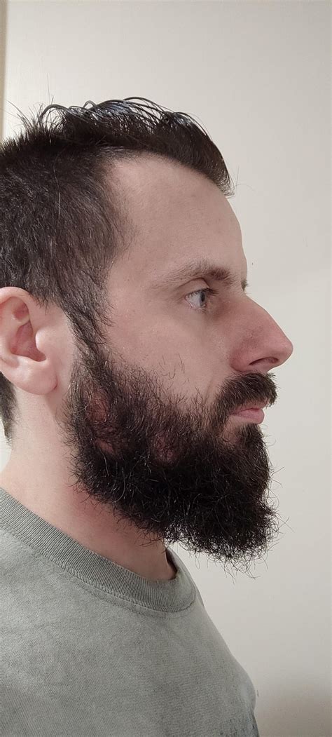 Started Alopecia Treatment Should I Shave Whole Beard Untill I See