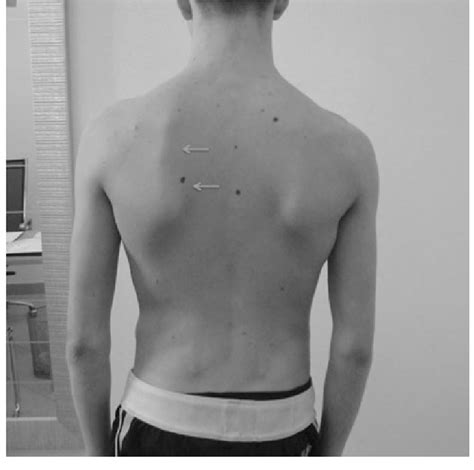 Type Ii Scapular Dyskinesis Download Scientific Diagram