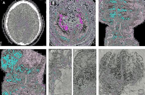 Cerebral Hyperperfusion Syndrome By The Numbers Transient F Operative Neurosurgery